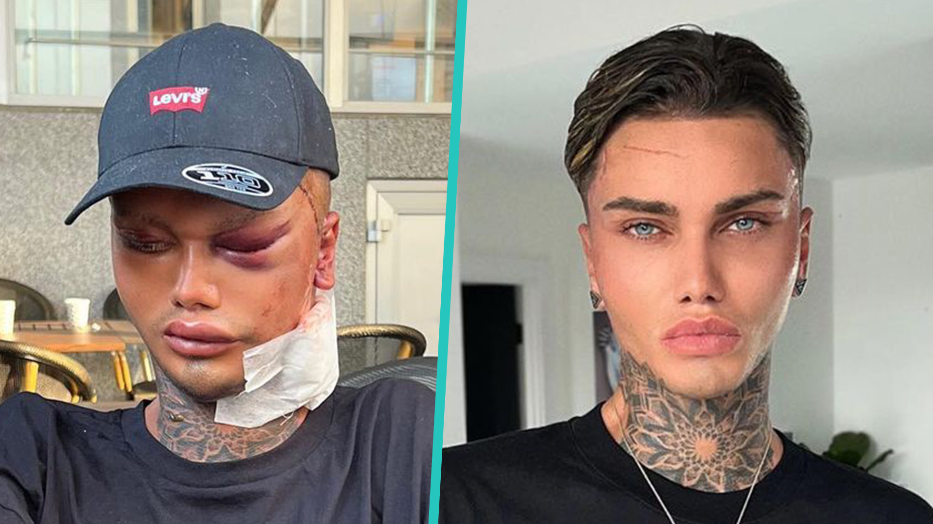 TikTok Star Levi Jed Murphy Reveals New Face After Undergoing 5 Plastic ...