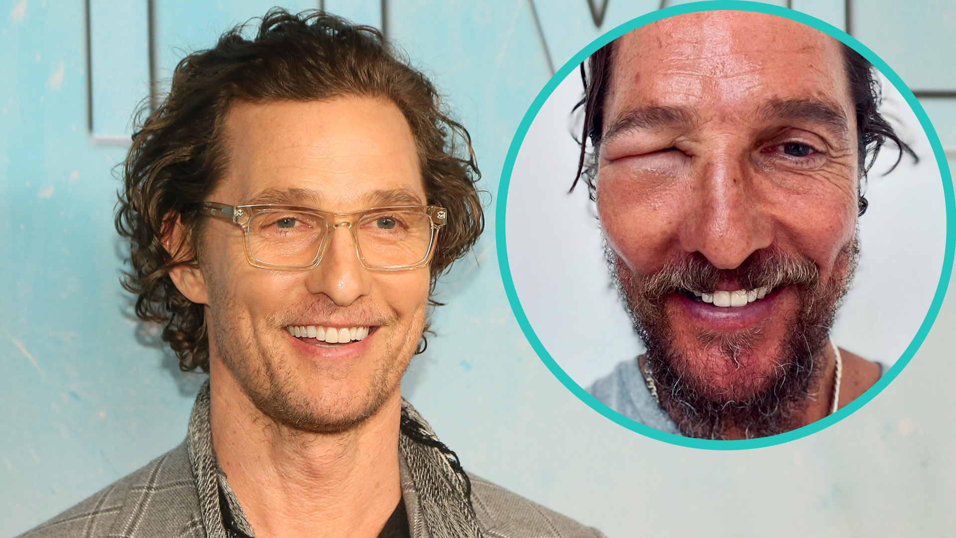 Matthew McConaughey's Eye Swells Shut In Startling Bee Sting Photo | Access